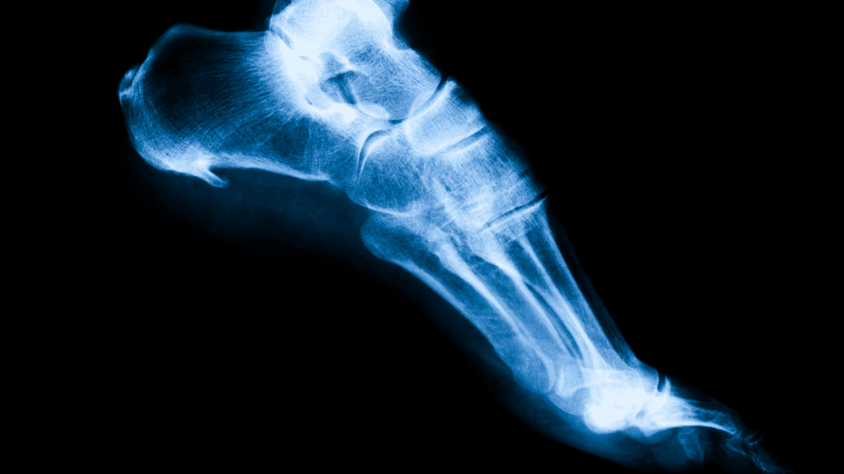 The Formation and Impact of Bone Spurs - Precision Spine Care