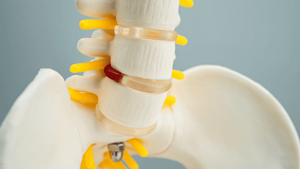 What Is Spondylosis? | Precision Spine Care